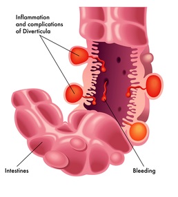 Causa y Manejo de Divertículos - Pregúntale a Frank