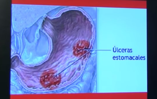 ¿Cómo sanar una úlcera? - Pregúntale a Frank